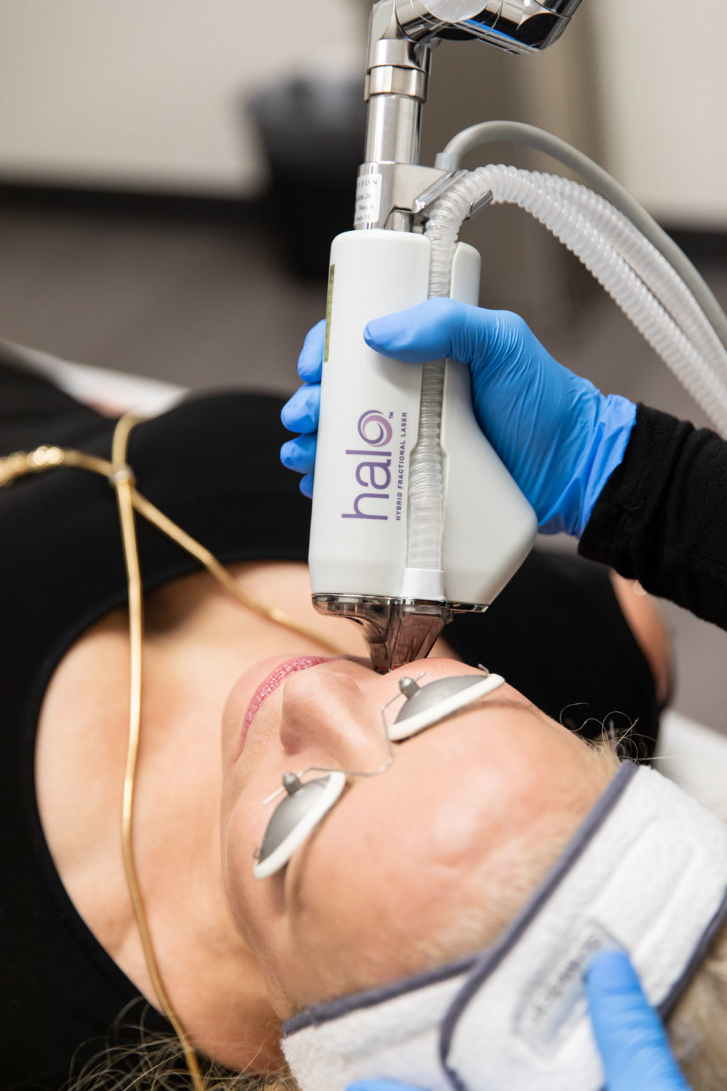 HALO Skin Resurfacing Special Face & Neck $1550 - SMooth Solutions Medspa